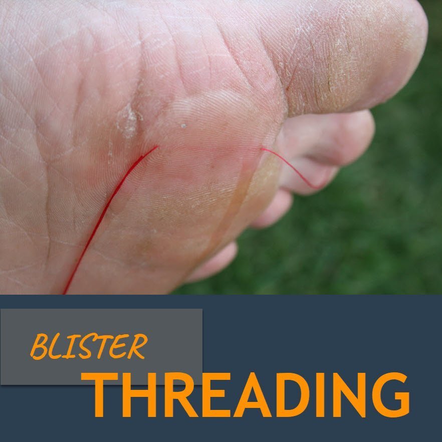How To Drain A Blister By Blister-Threading