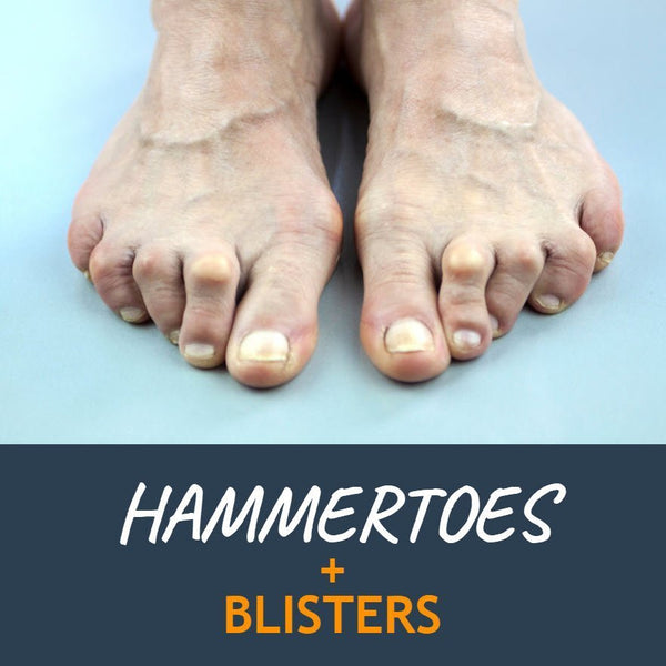 Hammertoes, Claw Toe, Mallet Toe And Blisters
